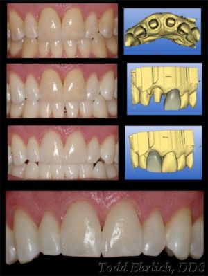 Ivoclar Vivadent's Emax CAD Replaces Empress 2 Crowns - Digital Enamel