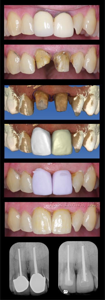 Christmas in August with CEREC and Emax CAD - Digital Enamel