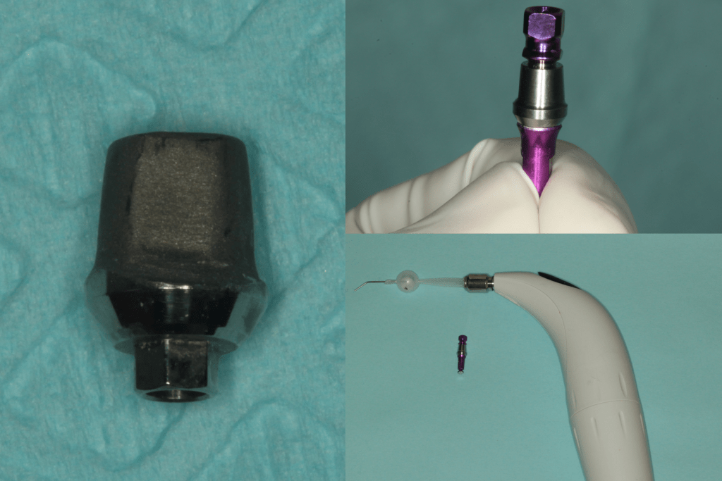 I'm Bringing Powder Back: CEREC Guide Immediate Case with Air Abrasion ...