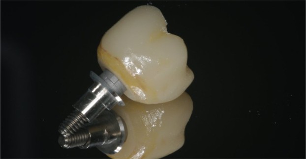 Emax, TiBase, and CEREC! Oh My! - Digital Enamel