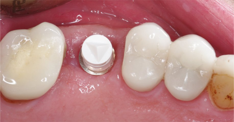 Emax, TiBase, and CEREC! Oh My! - Digital Enamel