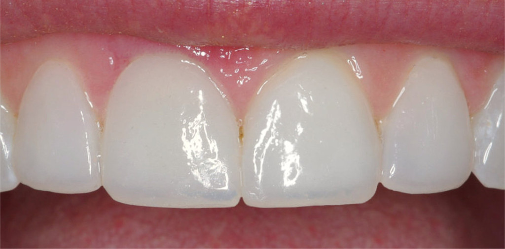 Emax Impulse O1 - Digital Enamel