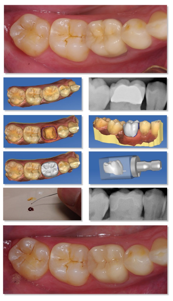 Cut the Cord! Just Predictable Omnicam and Emax CAD - Digital Enamel