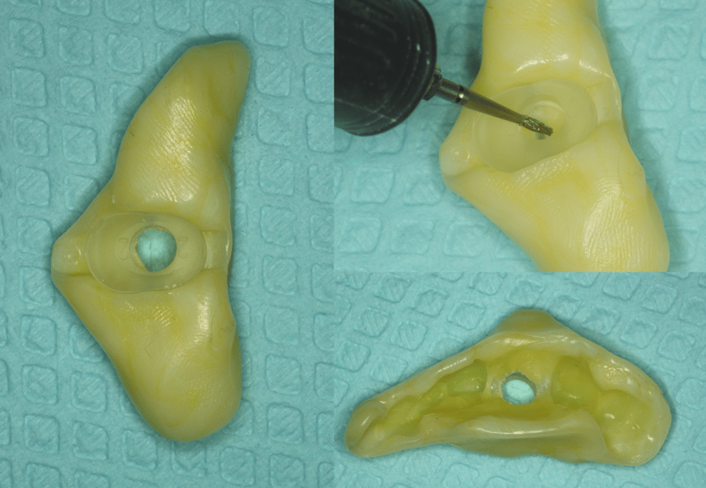 Una-Tooth: Large Edentulous Space, One Implant with CEREC Guide ...