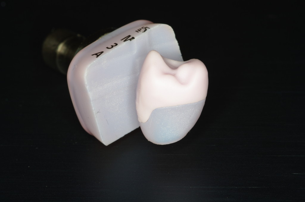 emax abutment - Digital Enamel