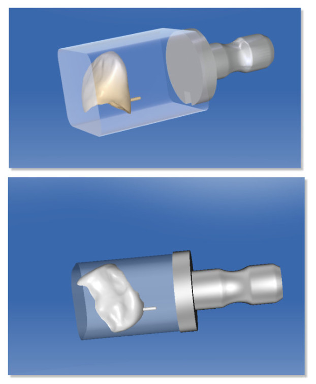Cerec blocks - Digital Enamel