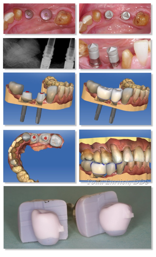 Long Span Bridge Updated with TiBase, Emax, and Cerec - Digital Enamel