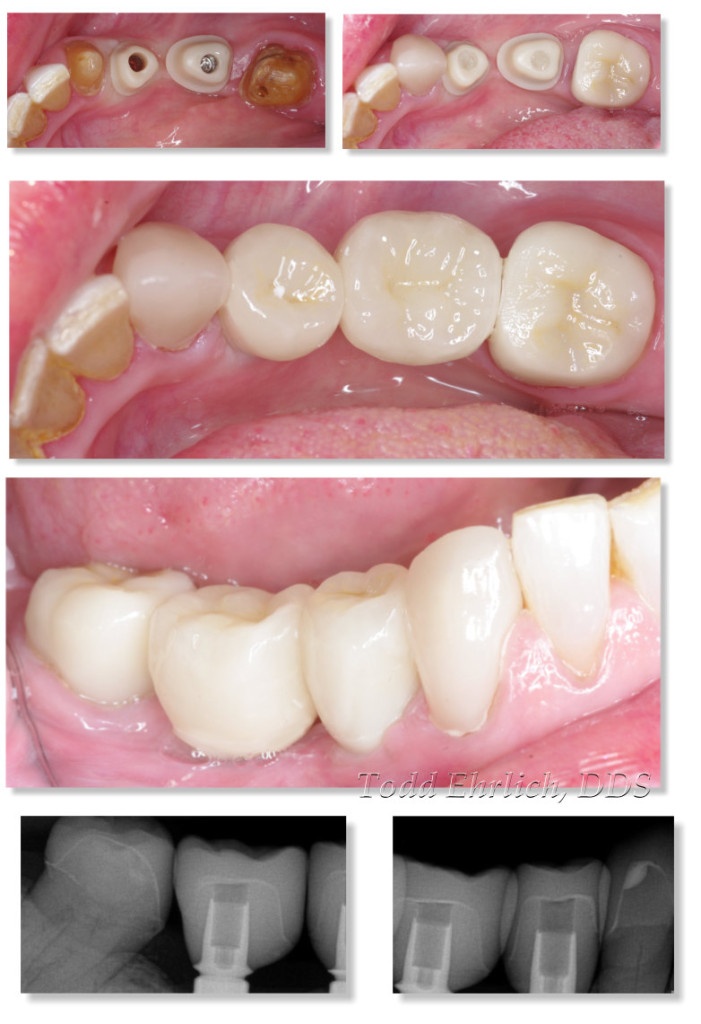 Long Span Bridge Updated with TiBase, Emax, and Cerec - Digital Enamel