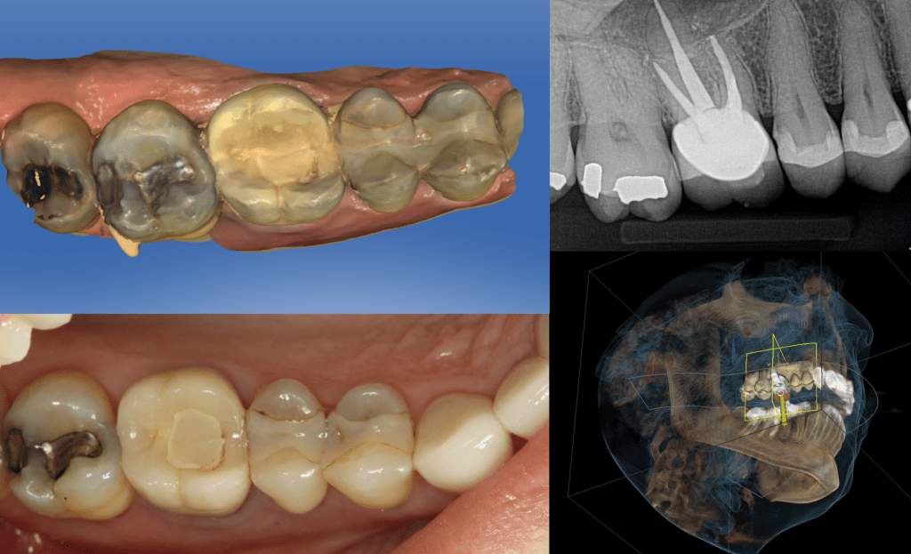 Hole in 3: Yet Another Immediate Molar Case with CEREC Guide and Legacy ...