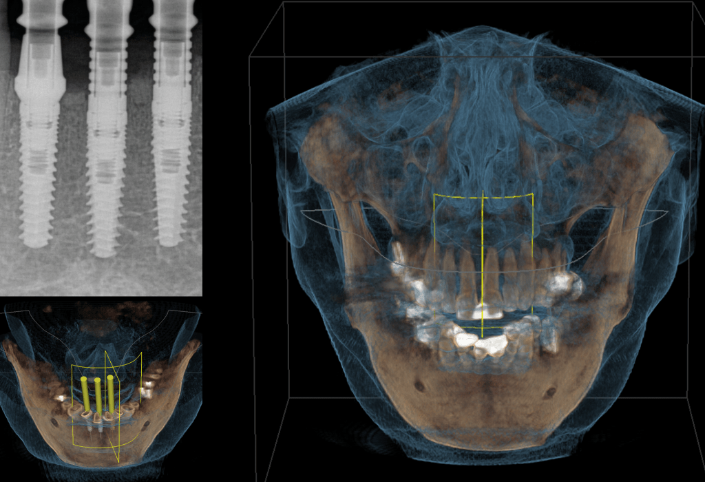 Getting Jiggy With It: Mini Hybrid with Intra Oral Verification Jig ...