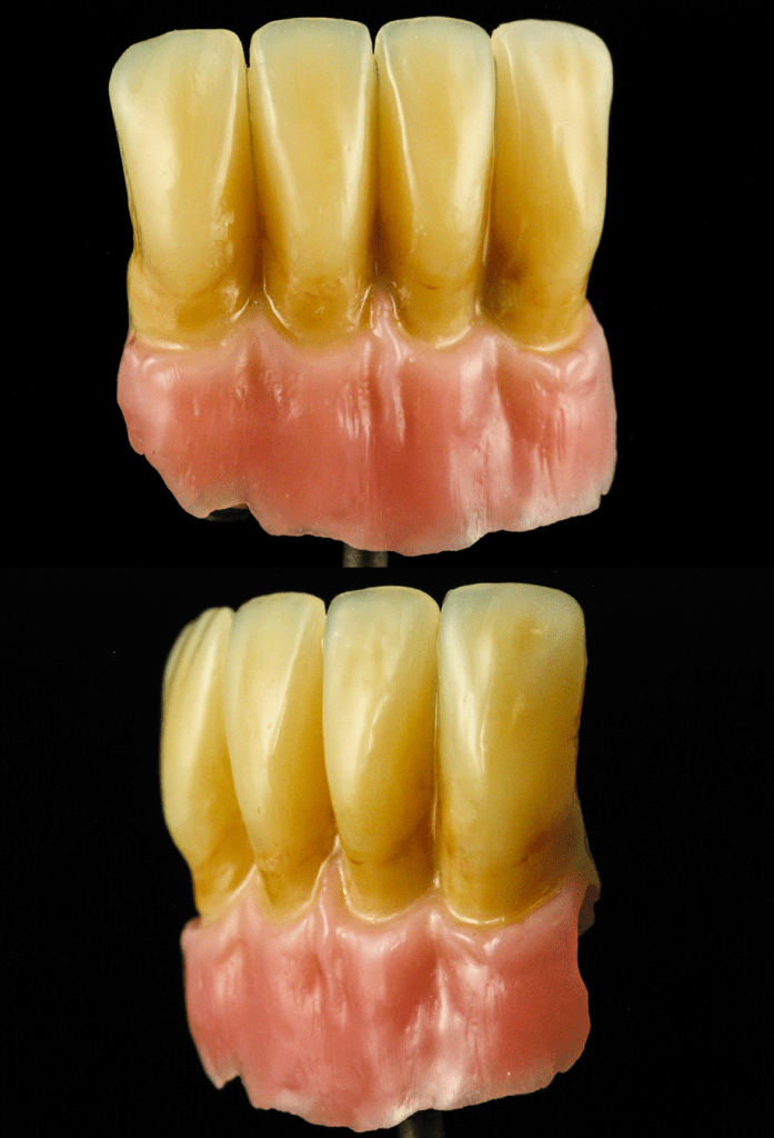 Getting Jiggy With It: Mini Hybrid with Intra Oral Verification Jig ...