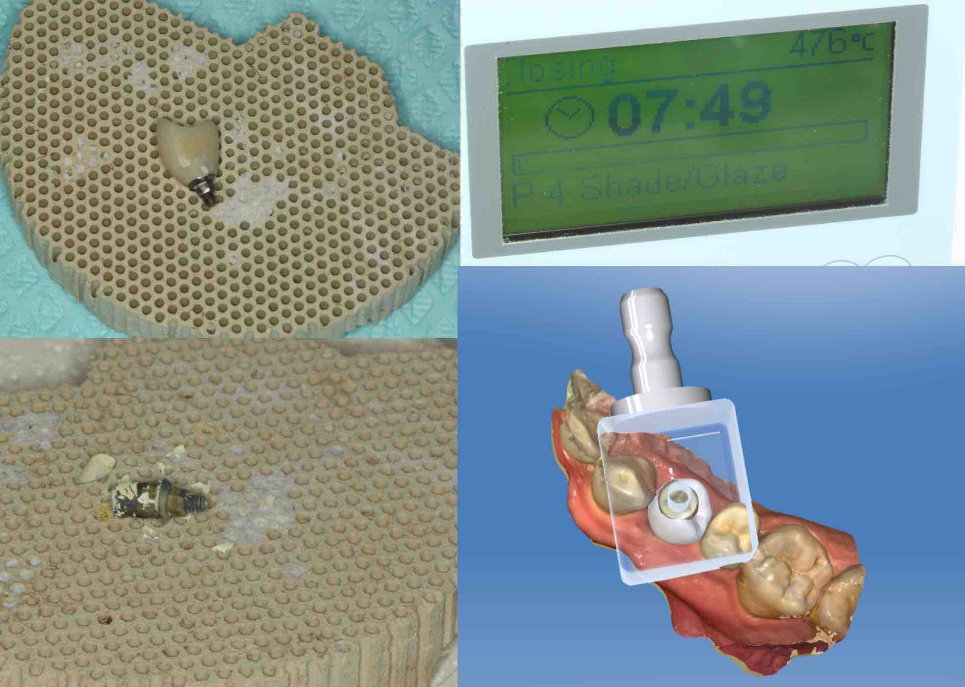 Temporary Cement is So Last Season: Bio Copy Telio CAD Immediate ...