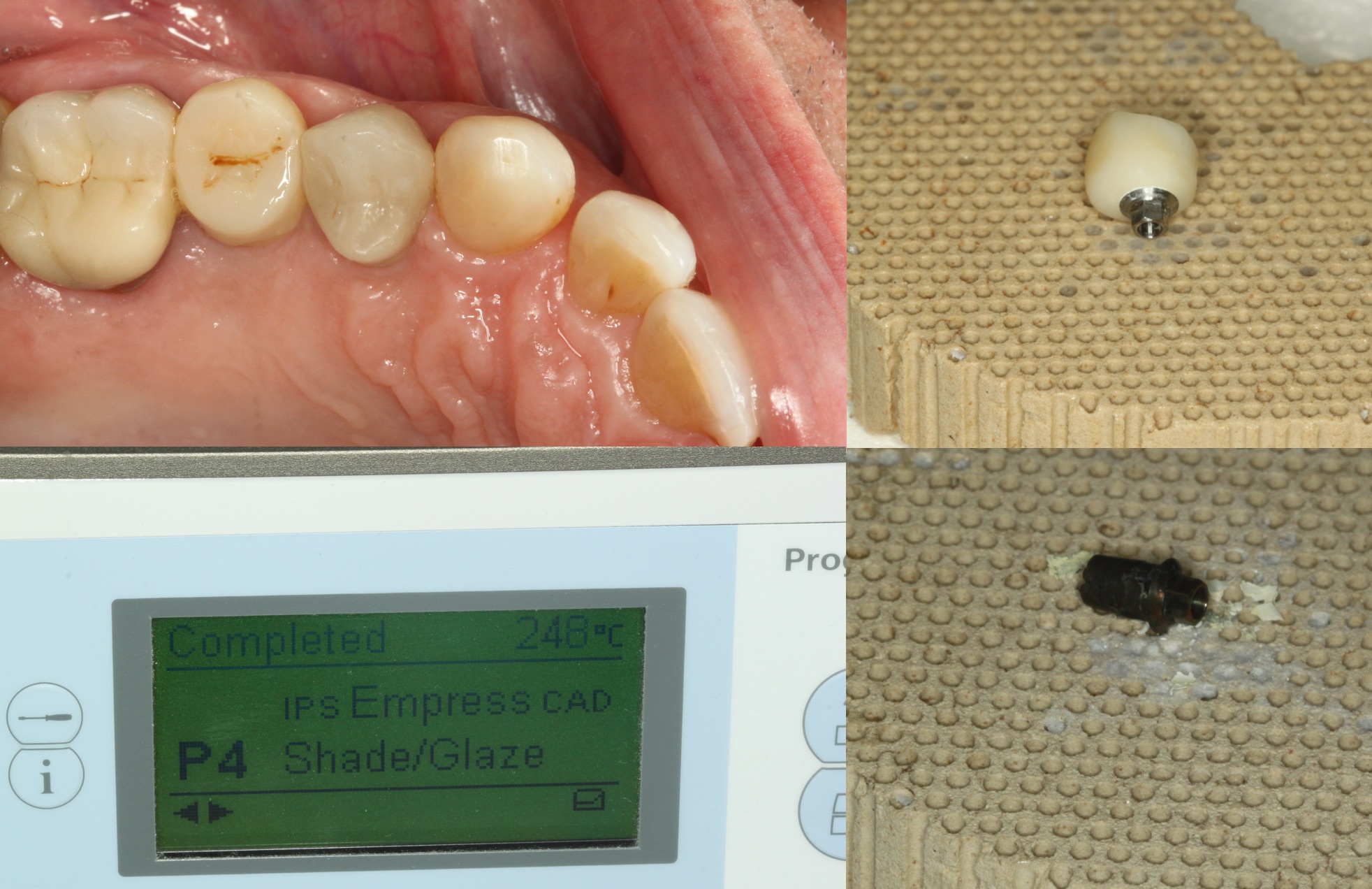 Tooth In A Day: Telio CAD Immediate Case with Grafting - Digital Enamel