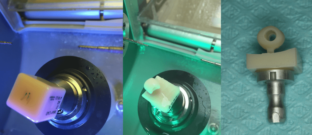 Tooth In A Day: Telio CAD Immediate Case with Grafting - Digital Enamel