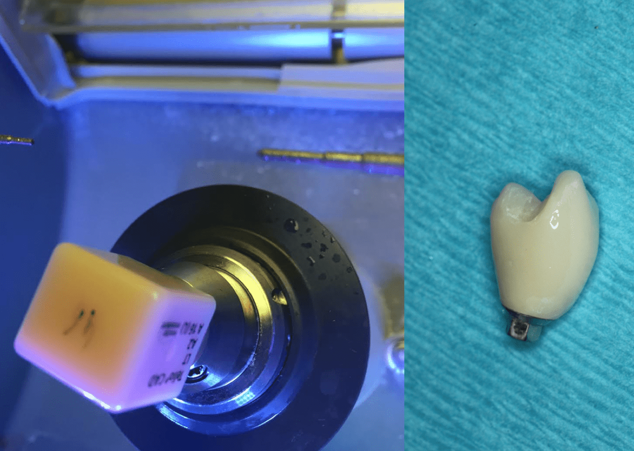 Temporary Cement is So Last Season: Bio Copy Telio CAD Immediate ...