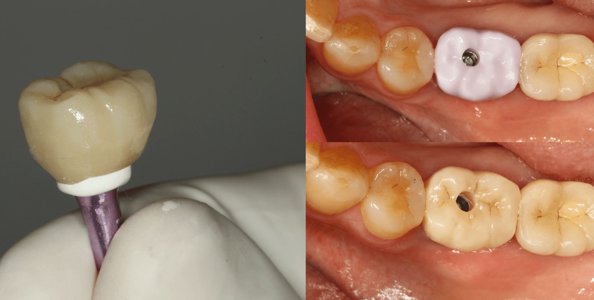 Roses Are Red Violets Are Lithium DiSilicate: Emax Case on a Legacy ...