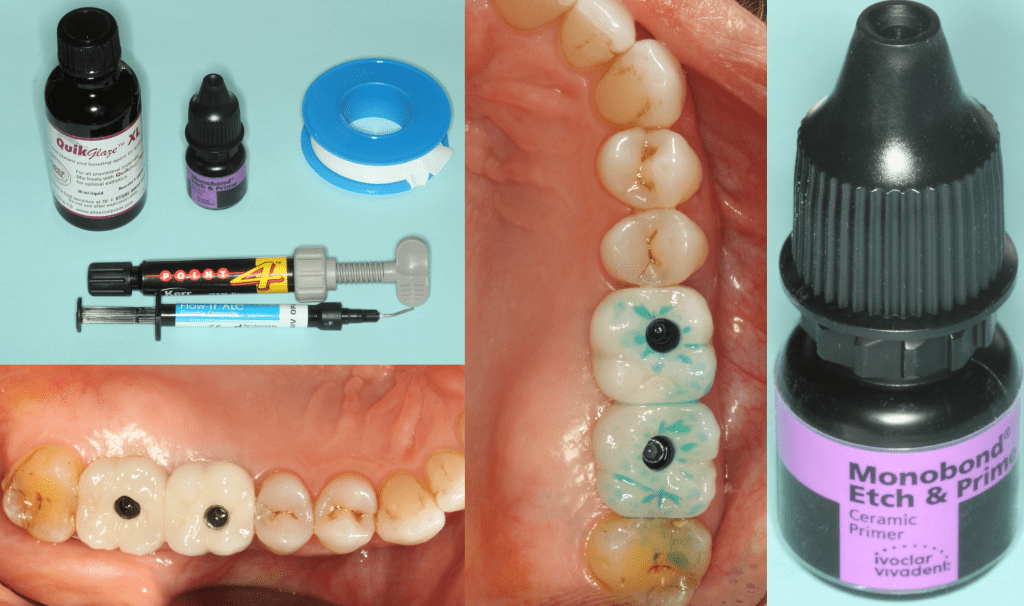 Hole-y You-Know-What! Opaquing Protocol with splinted UCLA type Screw ...