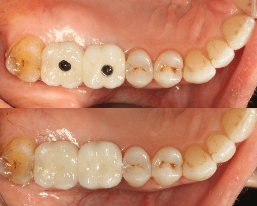 Hole-y You-Know-What! Opaquing Protocol with splinted UCLA type Screw ...