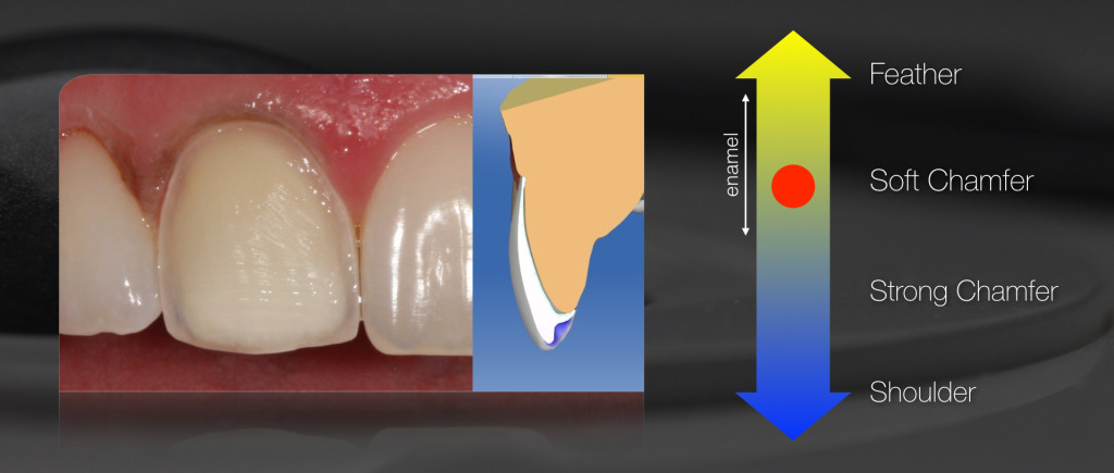 Feather margins in the CAD/CAM world - Digital Enamel
