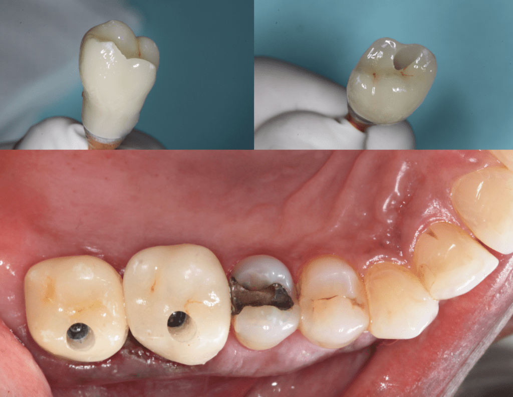 Deuces: Vita Enamic Implant Crowns on Legacy 7mm Implants - Digital Enamel