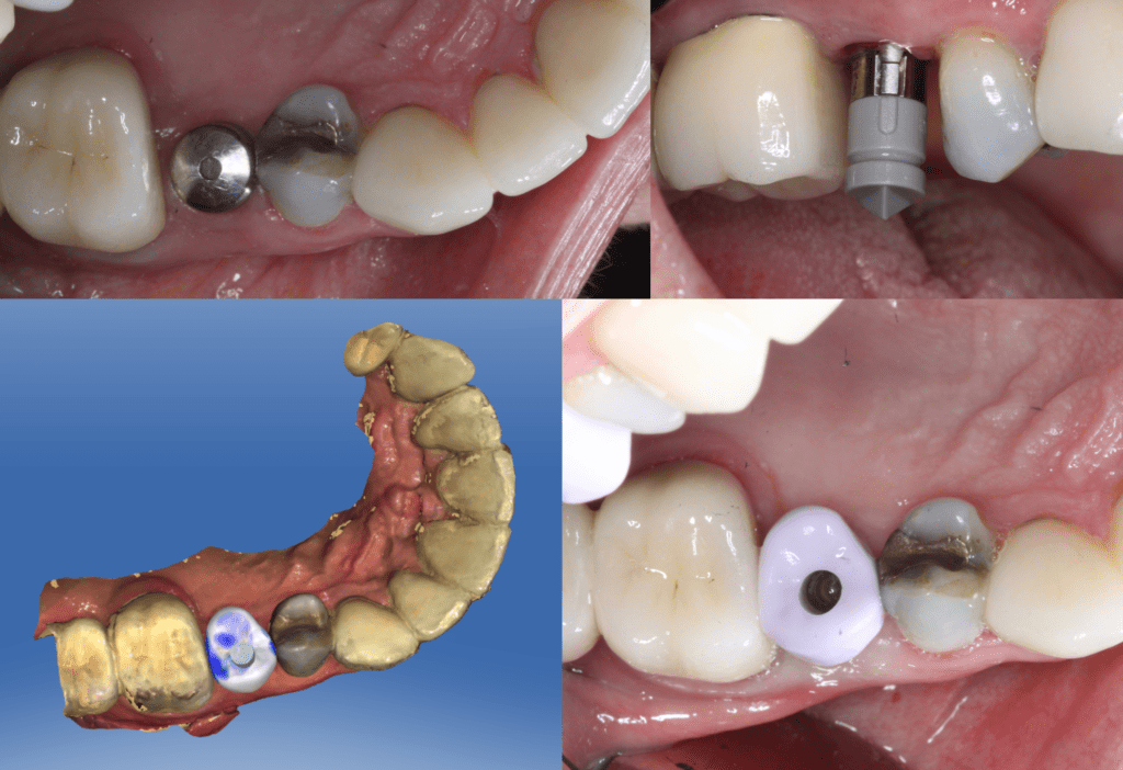 Bye Bye Bi: Pre Molar Immediate with CG2, Legacy 2 and Emax Screw ...
