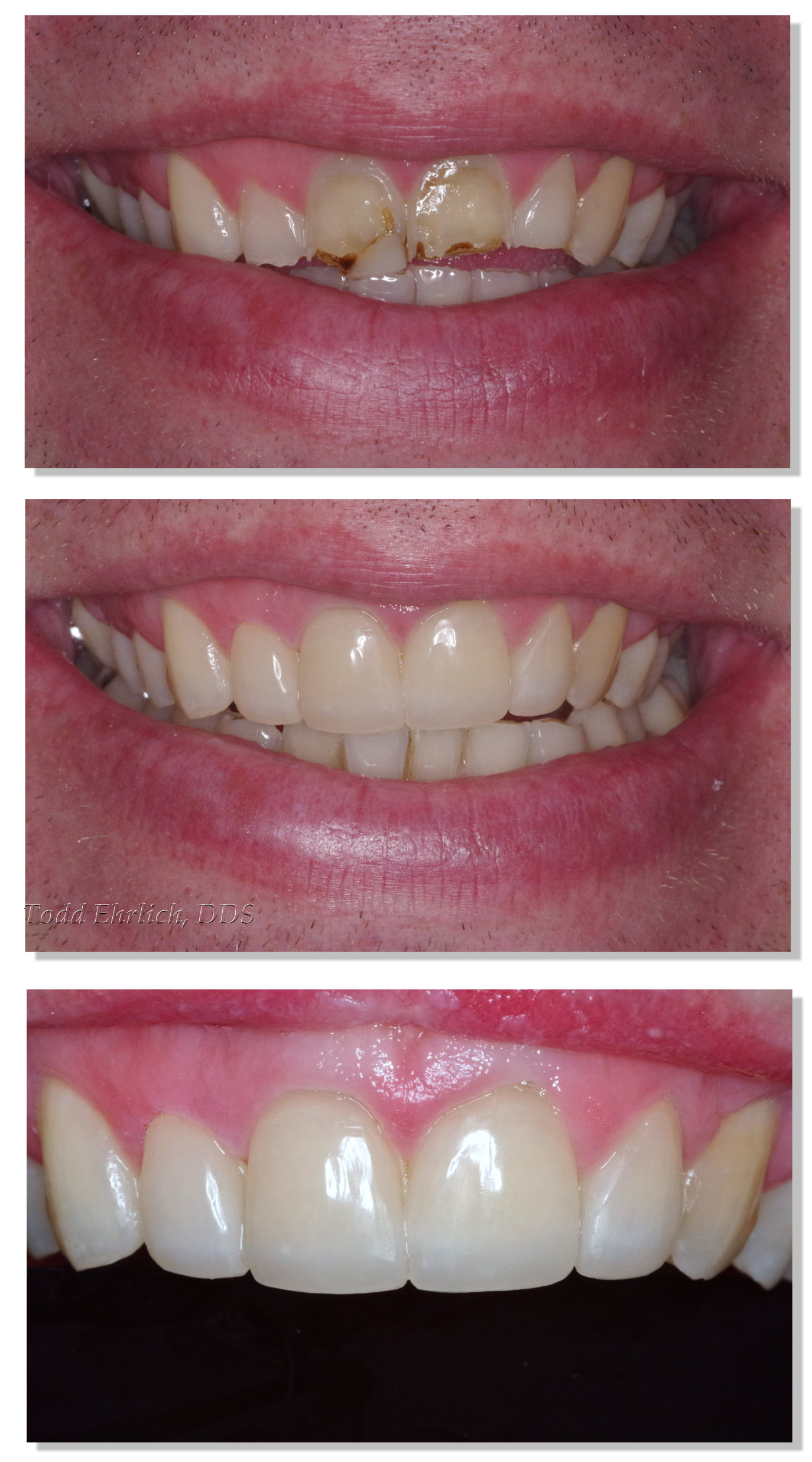 Enamic Multicolor CEREC 4.5 - Digital Enamel