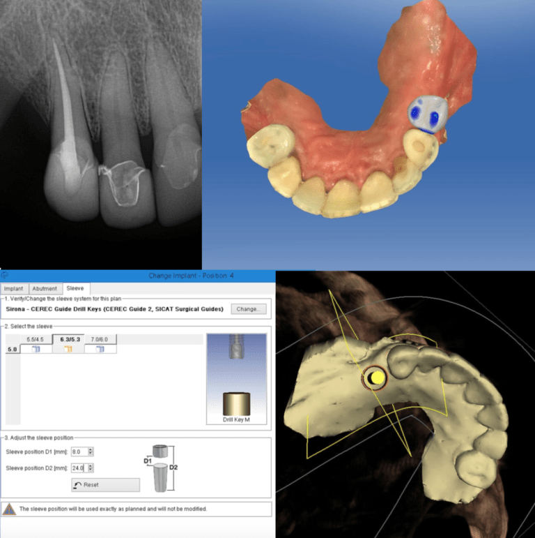 Kickin' Astra Part 2: CEREC Guide 2 Astra EV Sleeve Clinical Case ...