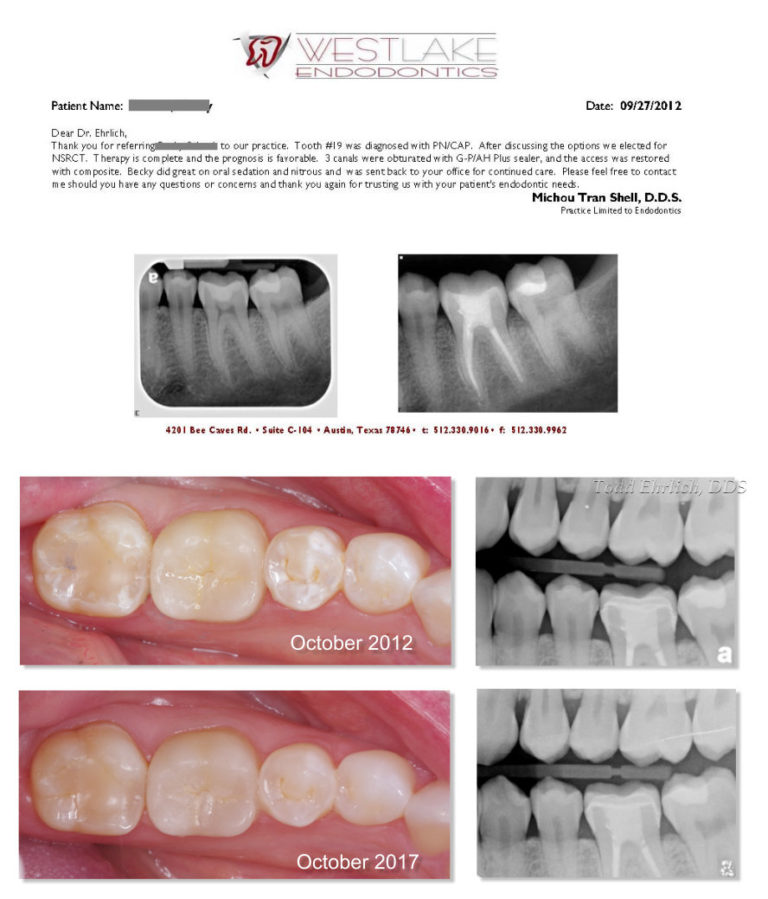 Five Year Recall CEREC and eMax CAD - Digital Enamel