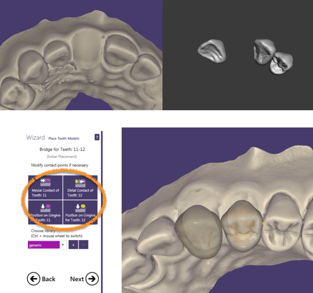 "Flipping" Out with CEREC and ExoCAD: 3D Printed Flippers - Digital Enamel