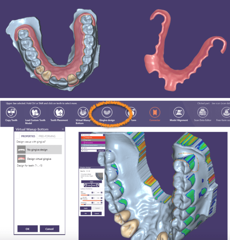 "Flipping" Out with CEREC and ExoCAD: 3D Printed Flippers - Digital Enamel