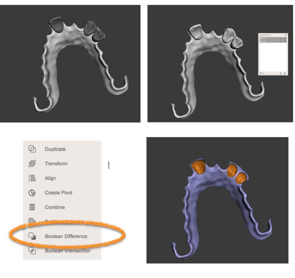 "Flipping" Out with CEREC and ExoCAD: 3D Printed Flippers - Digital Enamel
