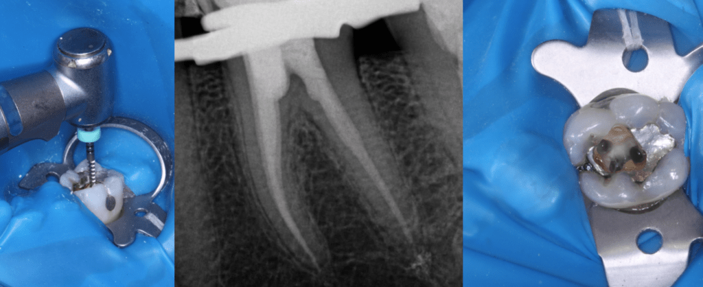 Best time for a CEREC Endo Guide? 2:30!! Root canal with printed CEREC ...
