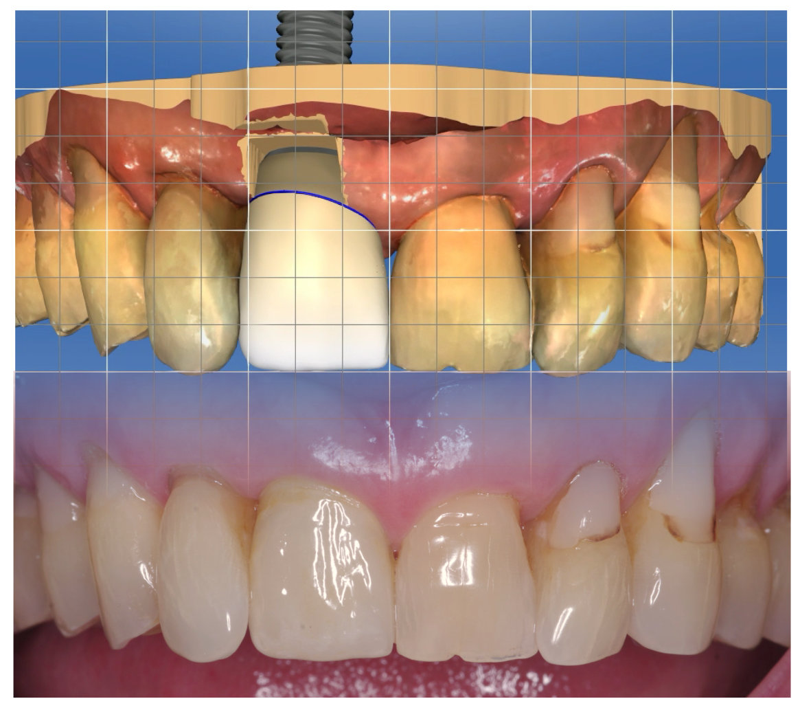 Implant Central Restored - Digital Enamel