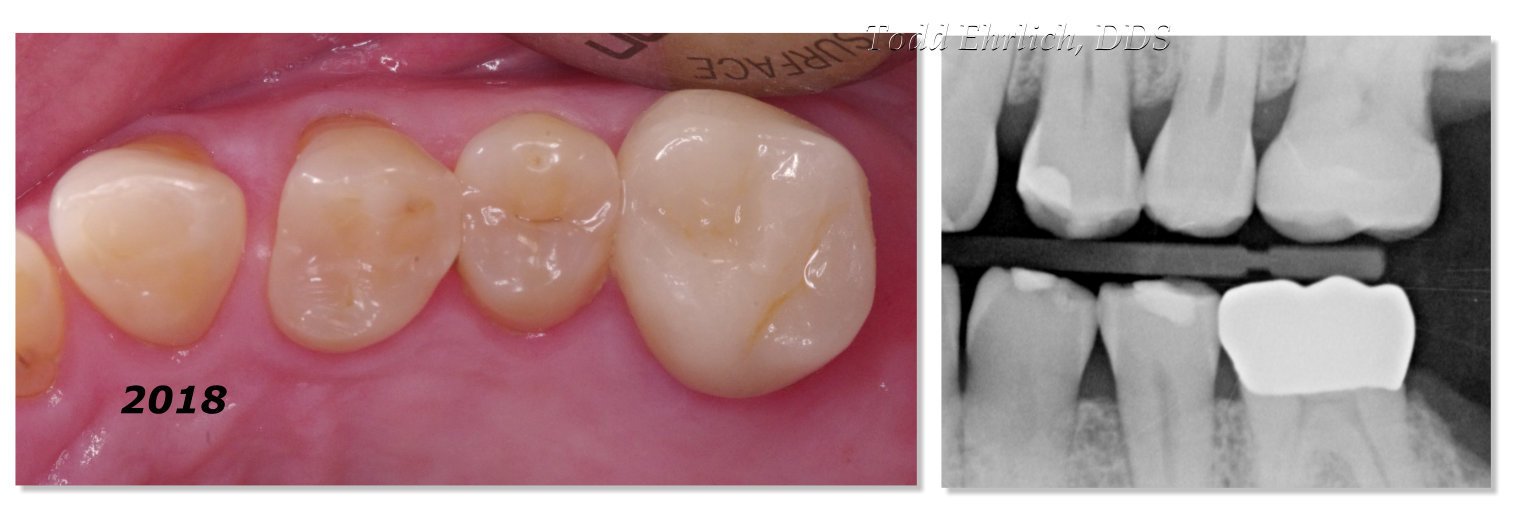 eMax CAD + Fuji Plus 6 Years - Digital Enamel