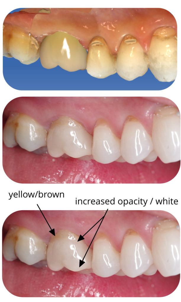 Buccal Staining 3 - Digital Enamel