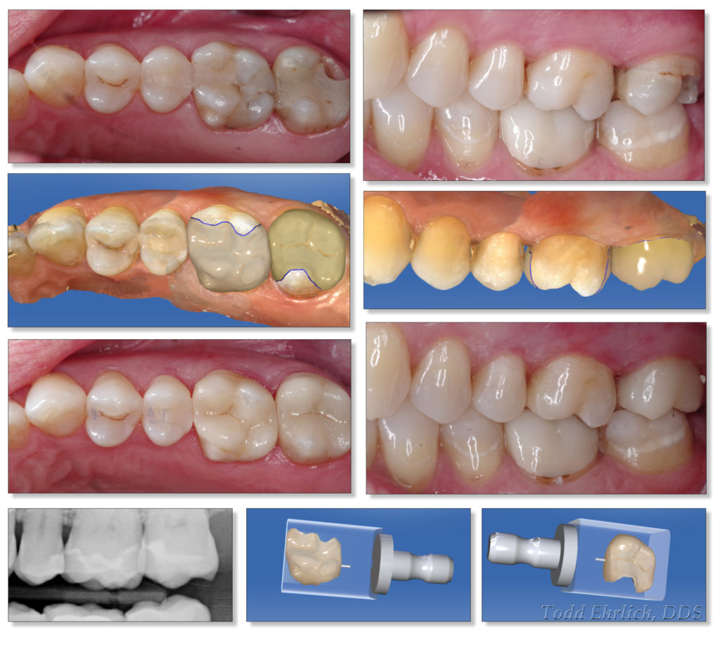 No Crowns Necessary with eMax CAD - Digital Enamel