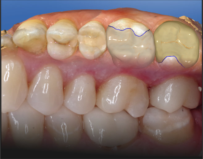 No Crowns Necessary with eMax CAD - Digital Enamel