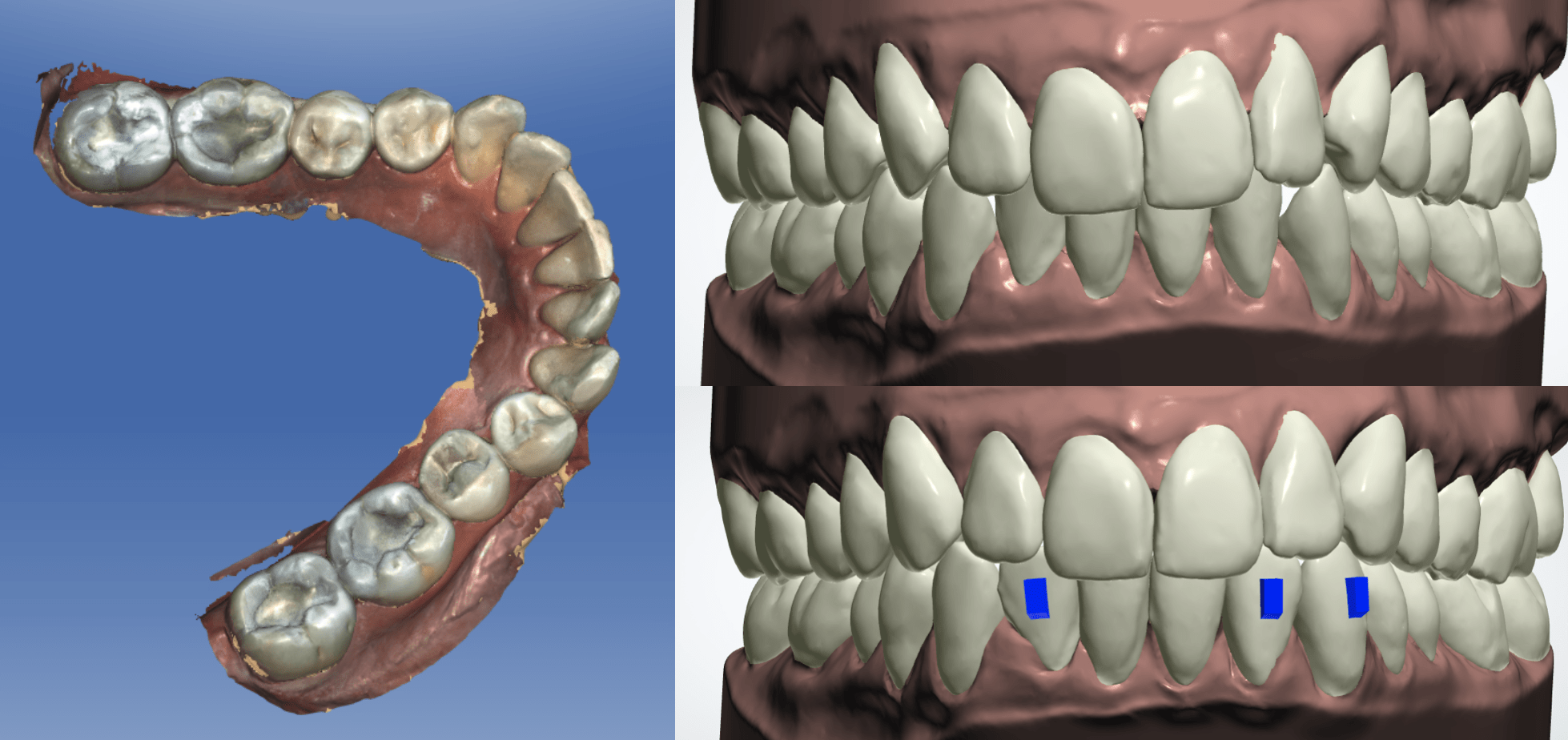 Back In a Slash with More Cash: $99-$150 Clear Aligner Designs From ...