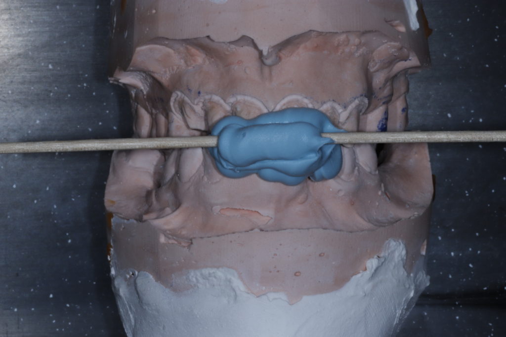 Solving a Maxillary Cant Chairside - Mobile Alabama Dentist | Dr ...