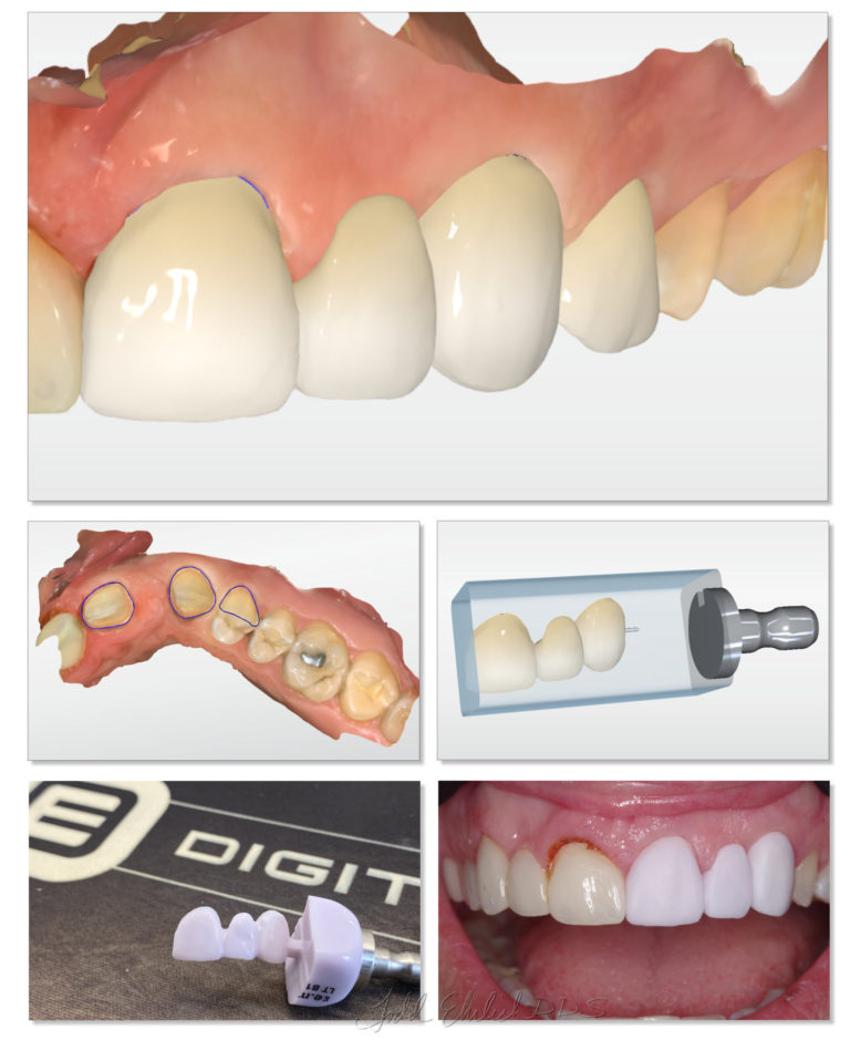 eMax Bridges 2 Left side - Digital Enamel