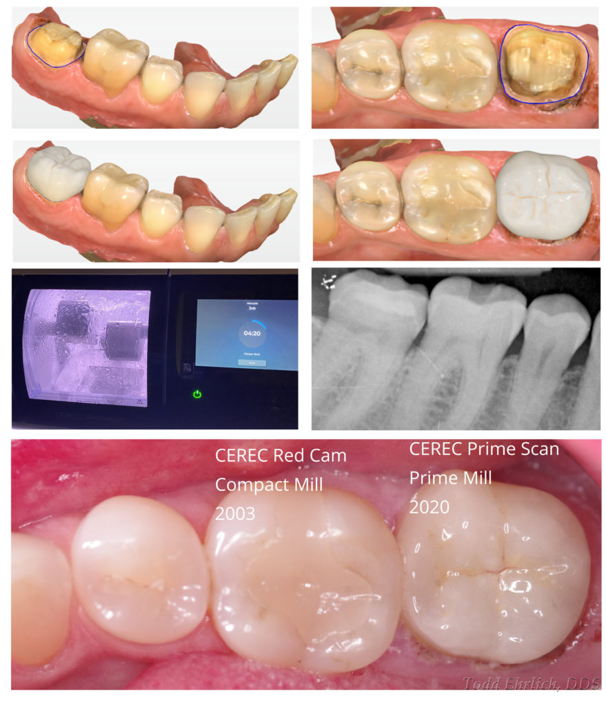 eMax Has Been Prime Milled! - Digital Enamel