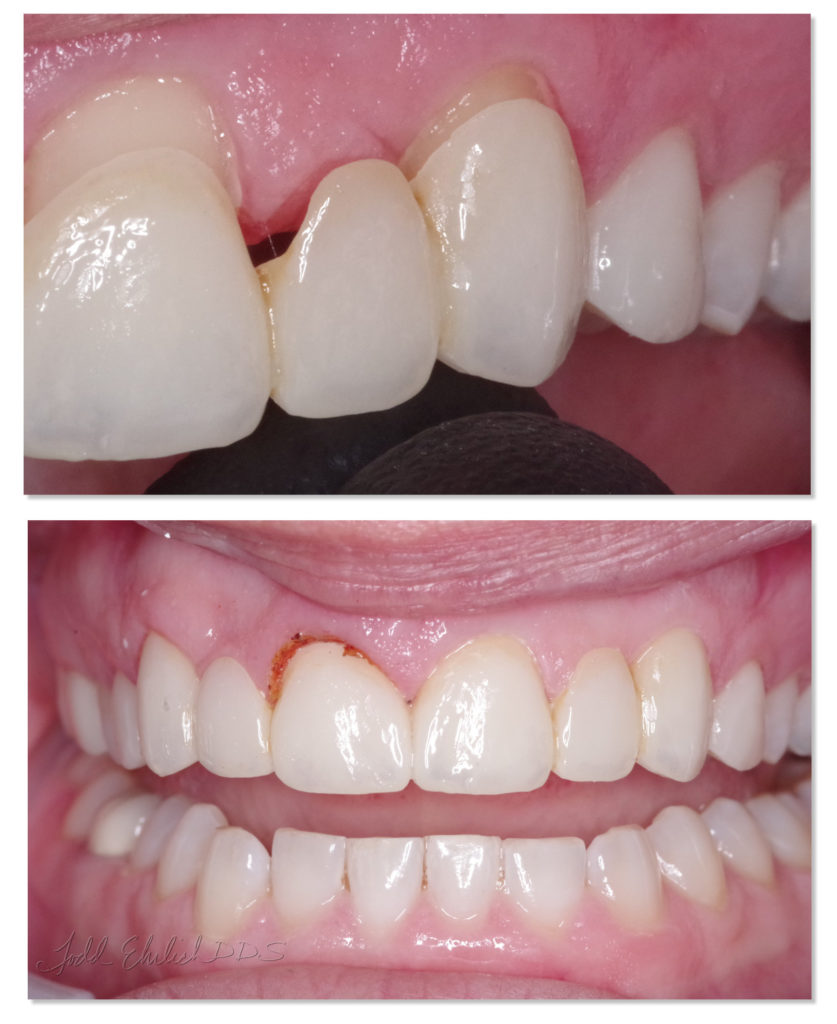 eMax bridges 3 left side inserted - Digital Enamel