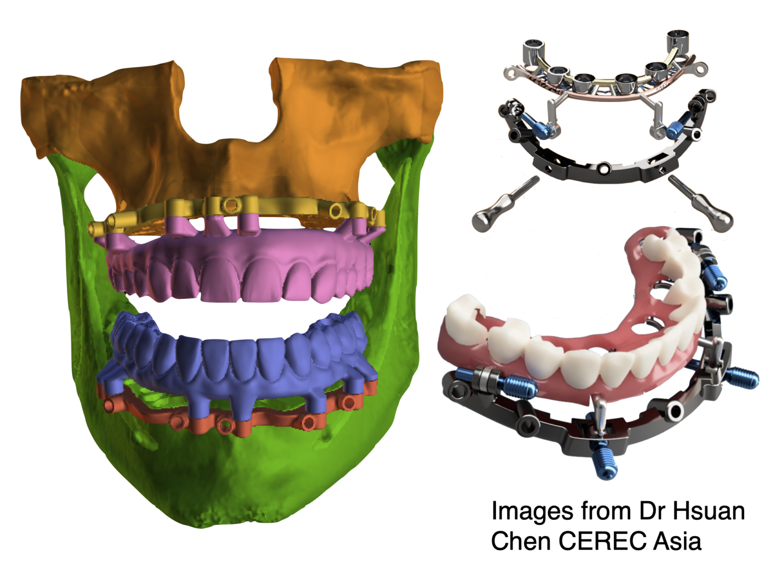 Stackable Guide Case with OnX resin and Magnetic Frame - Digital Enamel